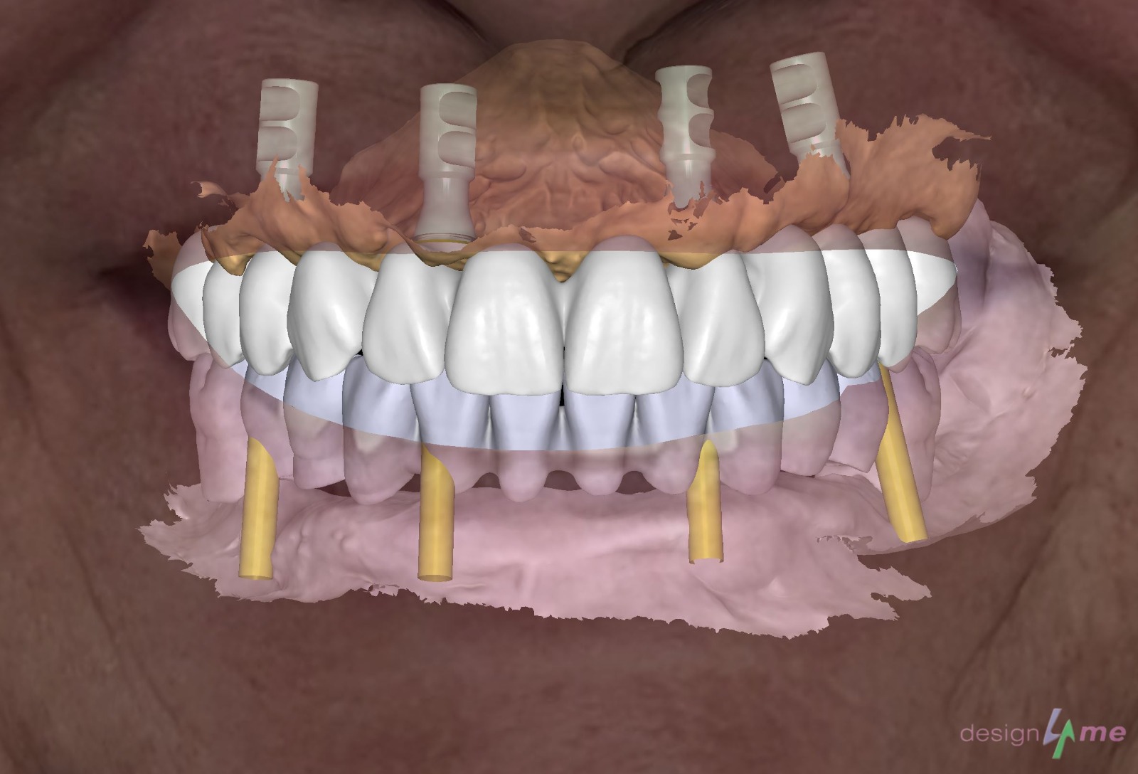 design4me - modelisations 3d de prothèses dentaires pour laboratoires ...